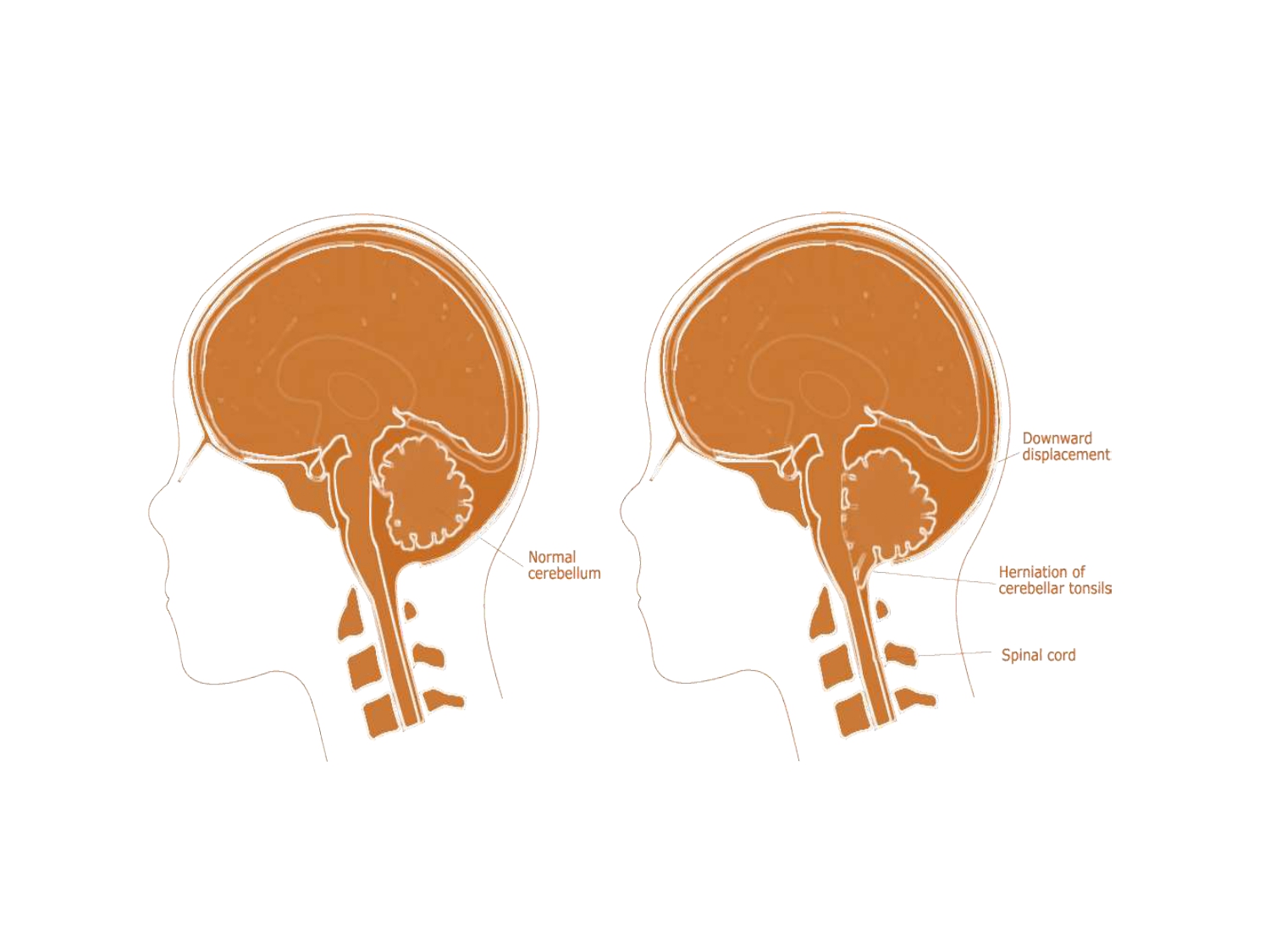 Chiari Malformation - GloNeuro