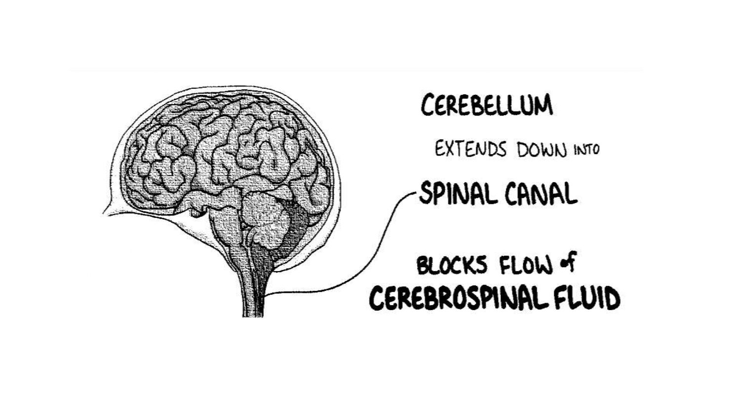 Chiari Malformation - GloNeuro