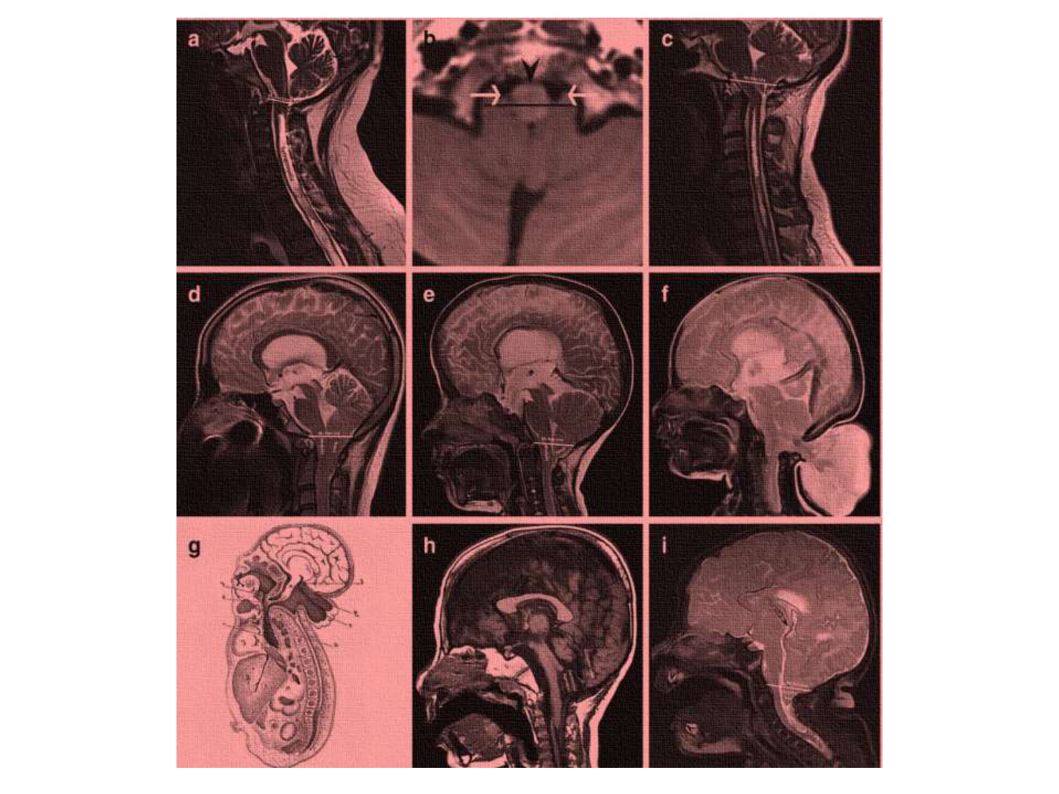 Chiari Malformation - GloNeuro
